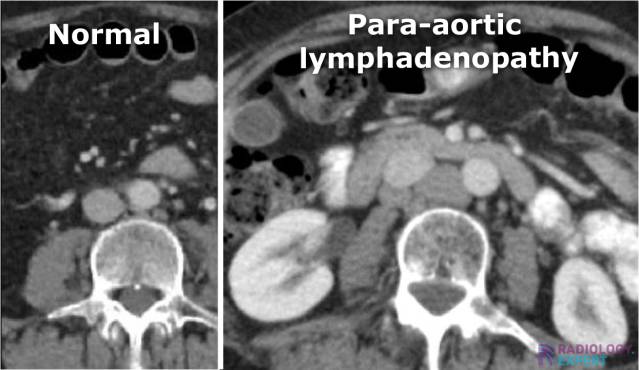 Ct Abdomen General
